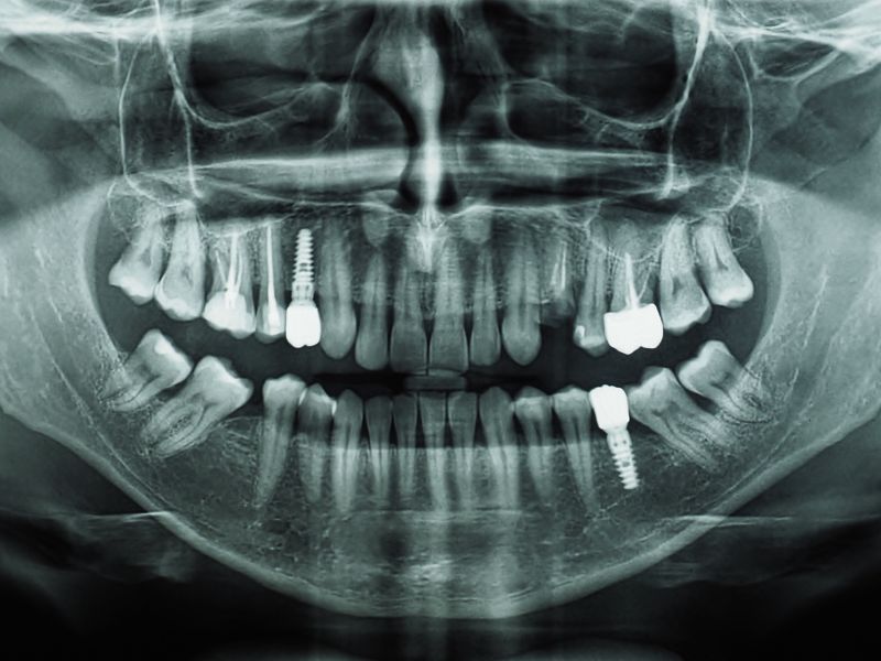 Pantomogram w diagnostyce stomatologicznej | Blog Bez Tabletek